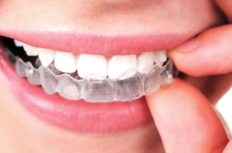 *3D animation" is an essential part of Invisalign treatment. - Dental ...